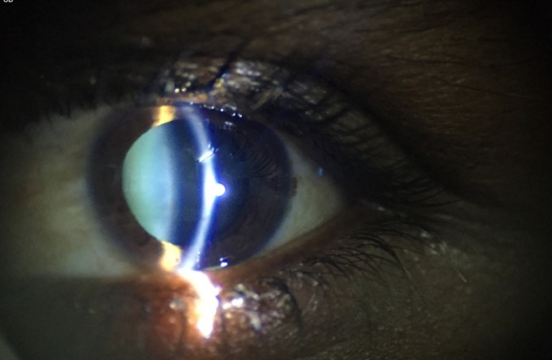 Remidio PSL D20 | Hand Held Portable Slit Lamp